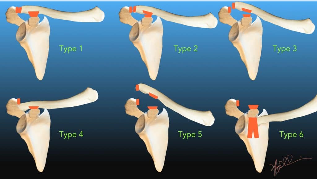Common Shoulder Injuries: AC Joint Sprain - MMD Chiropractic